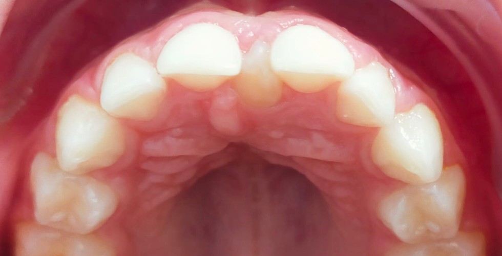 ¿Qué son los dientes supernumerarios y cómo tratarlos?